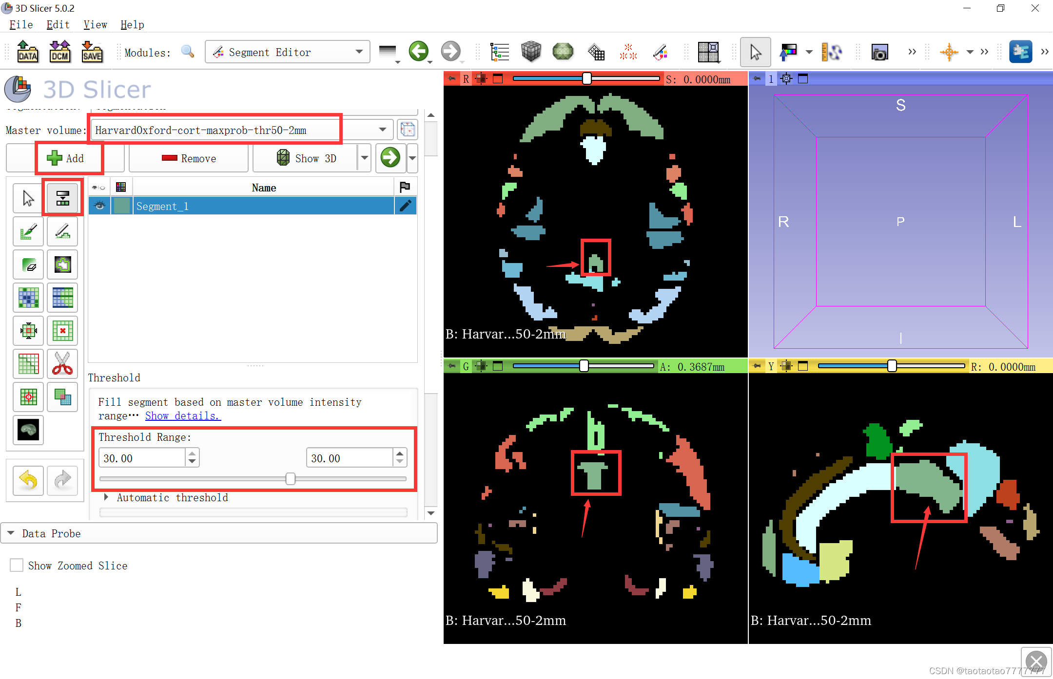 【影像组学】基于 atlas 感兴趣区提取 (3D slicer)_3dslicer 生成标准头模-CSDN博客