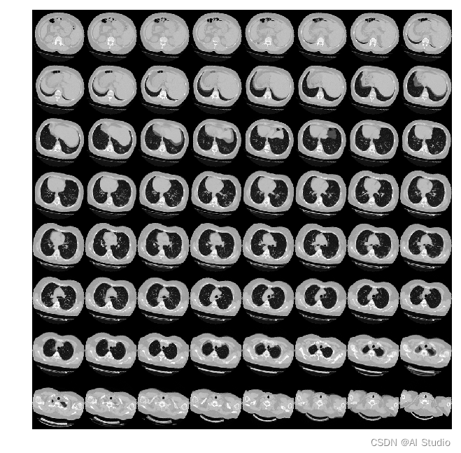 Mosmeddata 新冠肺炎胸部 Ct扫描数据集上基于3d Cnn实现二分类3d医学影像二分类网络 Csdn博客