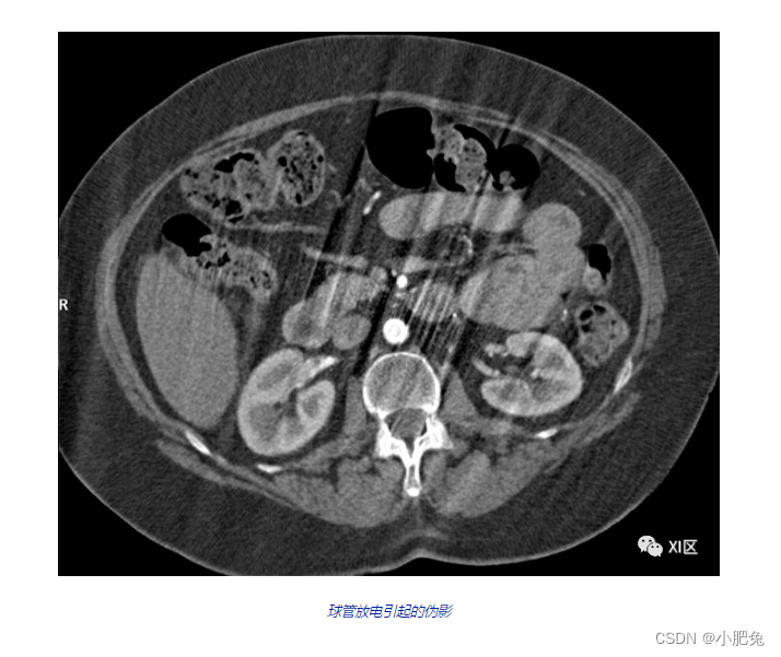 CT伪影：根本原因与规避方法_小鼠ct运动伪影-CSDN博客