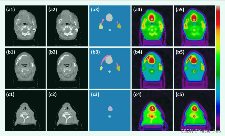 Head and neck multi-organ segmentation on dual-energy CT using dual ...
