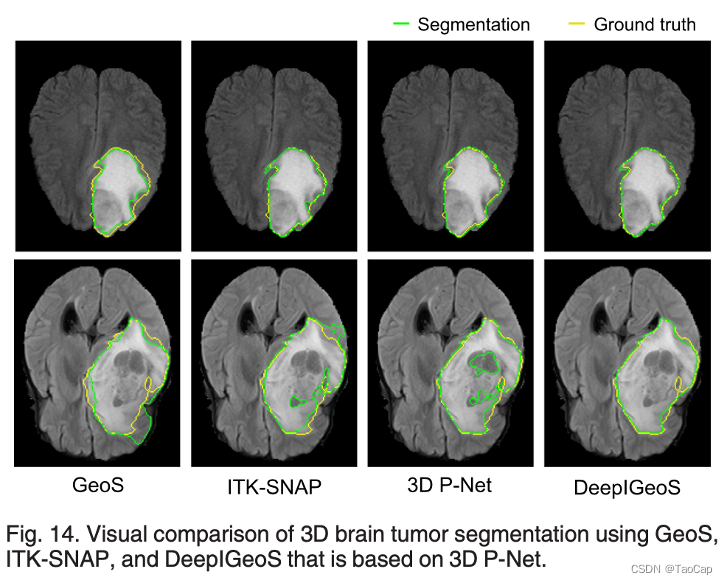 【笔记】DeepIGeoS: A Deep Interactive Geodesic Framework for Medical Image Segmentation-CSDN博客