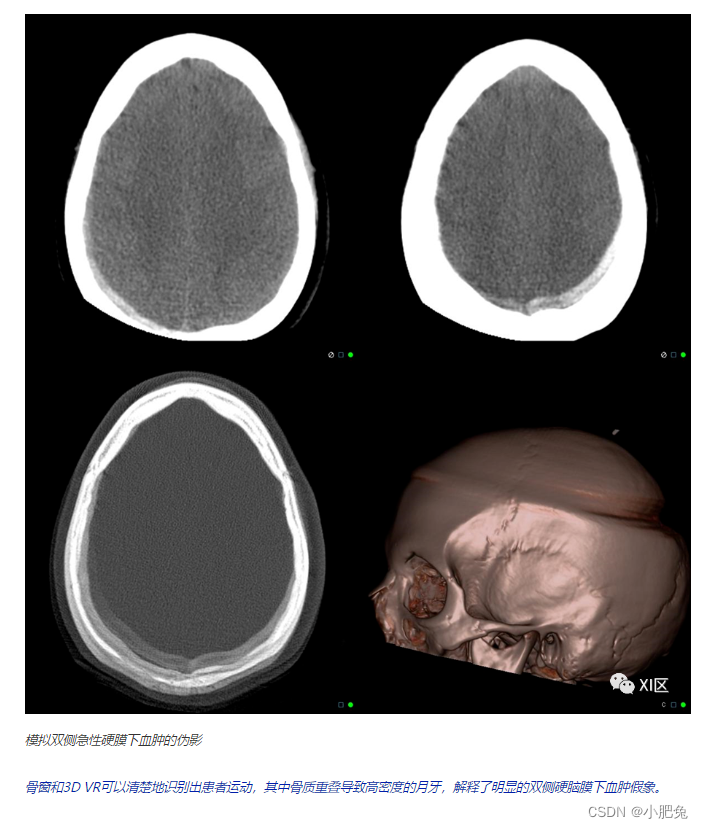 CT伪影：根本原因与规避方法_小鼠ct运动伪影-CSDN博客