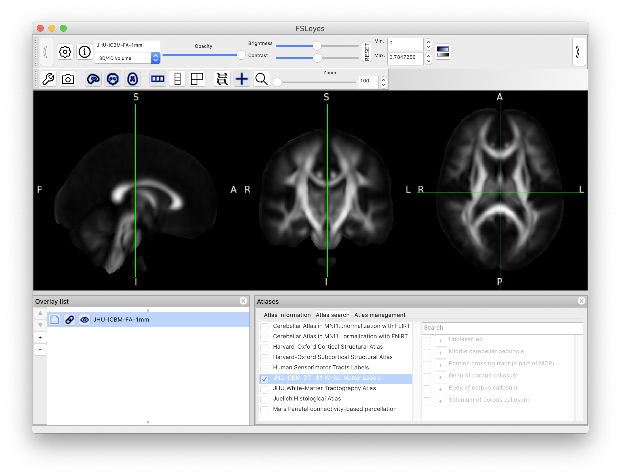 脑磁共振图像处理：SIM，DTIFIT，TBSS，FBA小记_freesurfer进行dti处理-CSDN博客