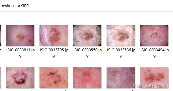 ISIC2018皮肤病分类数据集_isic2018数据集下载-CSDN博客