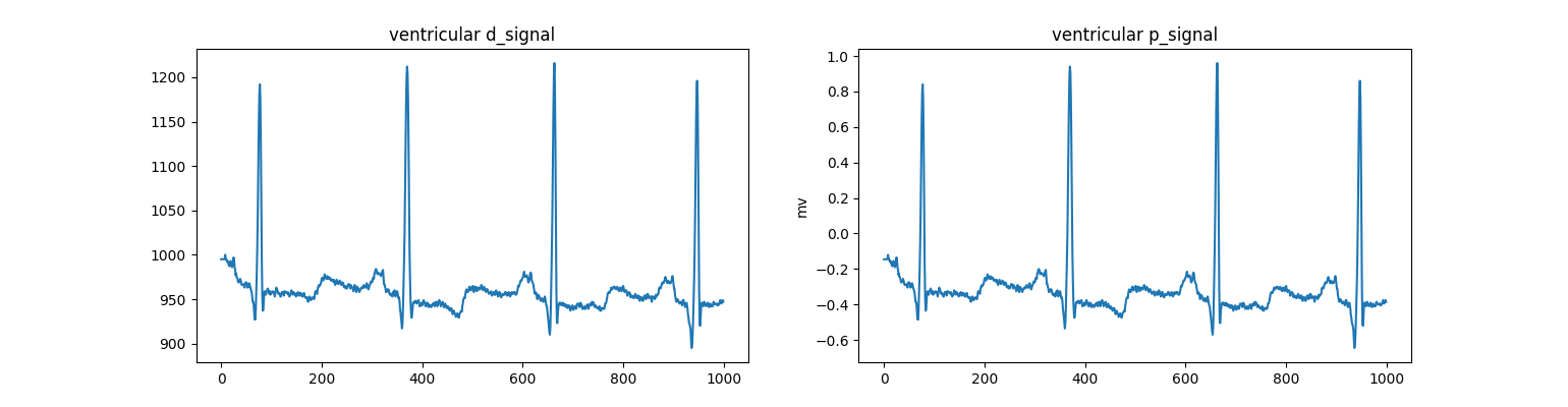 超入门级-基于中值滤波处理ECG信号的基线漂移-Python-MIT-BIH数据集_中值滤波去除基线漂移-CSDN博客