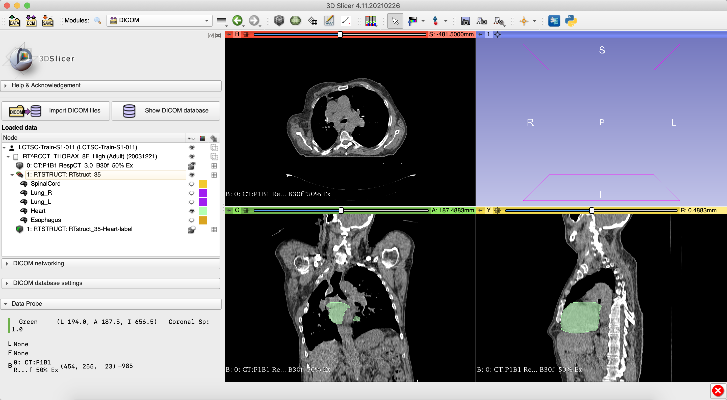 肺部CT分割挑战2017数据集下载和说明_吨吨不打野的博客-CSDN博客_ct 分割数据集