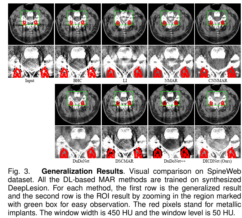 Deep Interpretable Convolutional Dictionary Network for Metal Artifact Reduction in CT Images_卷积 ...