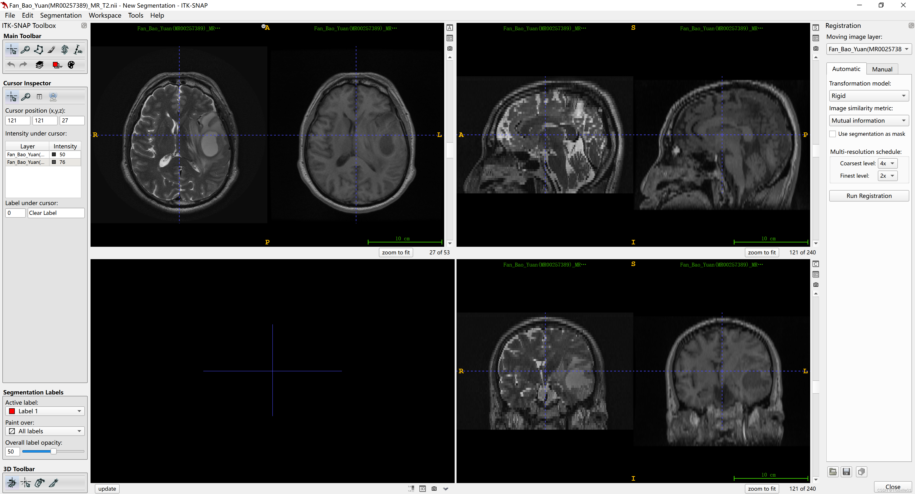 介绍一种医学影像配准的方法（使用itk-snap)_itksnap使用教程-CSDN博客