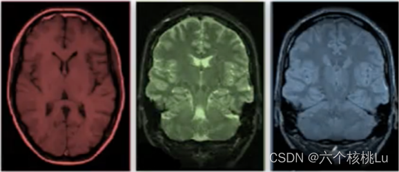 阿尔兹海默症分类识别（2D+3D模型）（数据集为3D MRI扫描图像）_阿尔兹海默症mri分类-CSDN博客
