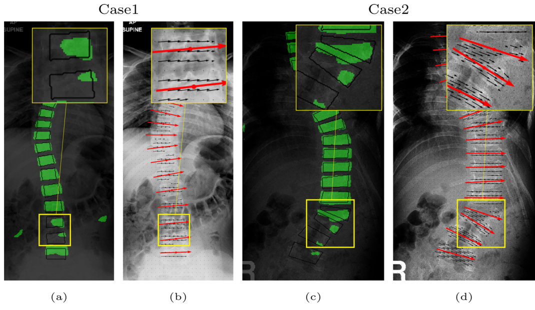 【翻译】★AutomationOfSpineCurveAssessment in ...