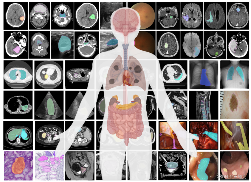 nature论文Segment anything in medical images_medsam: segment anything in medical images-CSDN博客
