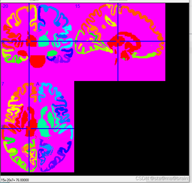 如何求NIfTI文件的MNI坐标，如求Desikan-Killiany，Schaefer2018等图谱的MNI坐标_desikan ...