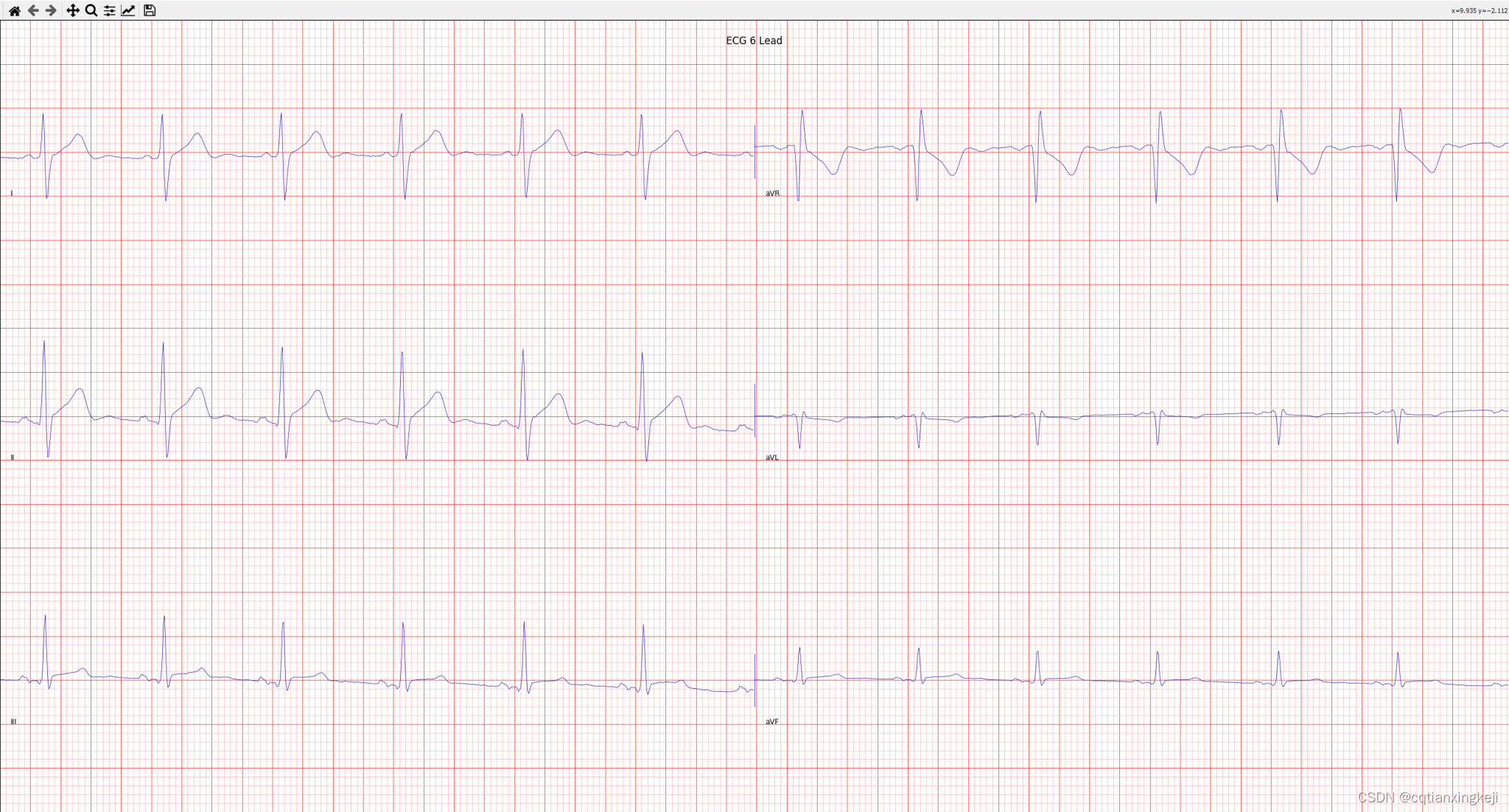 医疗器械ECG心电（全套资料）-ECG的实物图、原理图工程、PCB电路板、BOM、gerber、嵌入式源代码、GUI_ecg硬件采样-CSDN博客