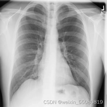 医疗影像数据集—CT、X光、骨折、阿尔茨海默病MRI、肺部、肿瘤疾病等图像数据集_医学图像分割mri数据集-CSDN博客