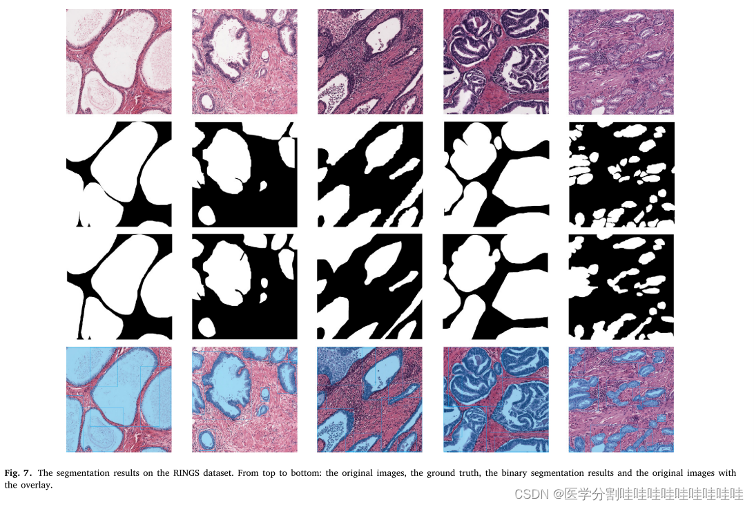 Enhancing gland segmentation in colon histology images using aninstance-aware diffusion model-CSDN博客