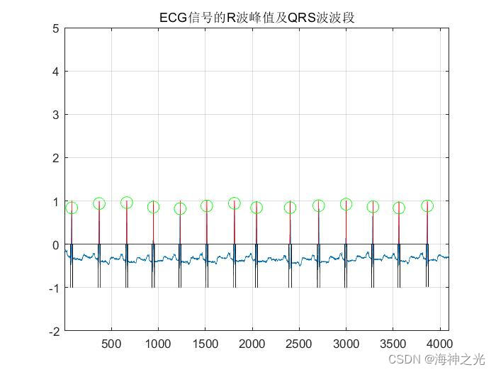 【心电信号ECG】小波变换心电信号R波检测【含Matlab源码 3592期】_ecg r波-CSDN博客