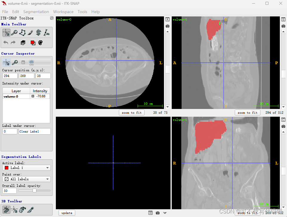 LiTS2017数据集介绍、下载与预处理_lits数据集下载-CSDN博客