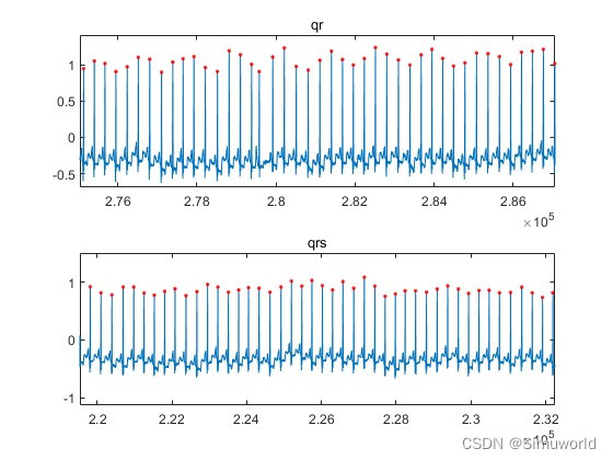心电信号QRS波检测matlab仿真_qrs波心电模拟器-CSDN博客
