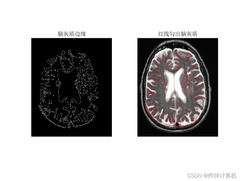 Matlab 区域生长法 基于区域生长法的脑白(灰)质的分割matlab区域生长法 Csdn博客