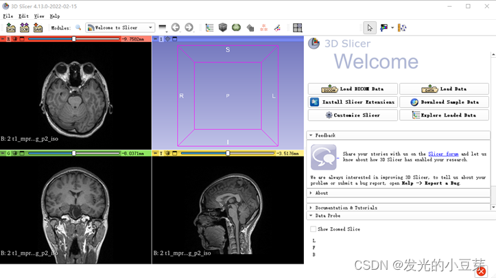 3D Slicer 制作个性化面具并导出保存为3D打印文件_3dslicer皮肤建模-CSDN博客