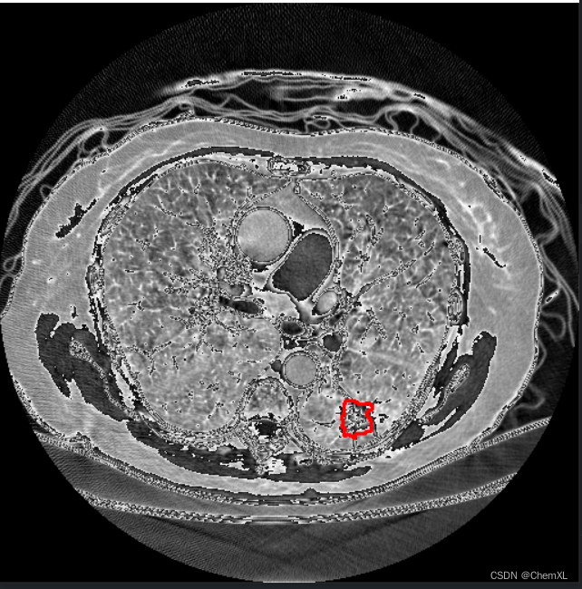 LIDC-IDRI数据集-CSDN博客