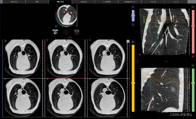 NewTomNNT意大利杰诺牙科口腔CT图像分析处理软件_nntviewer口腔ct如何调出曲断-CSDN博客