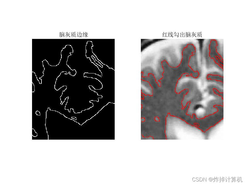 Matlab 区域生长法 基于区域生长法的脑白(灰)质的分割matlab区域生长法 Csdn博客