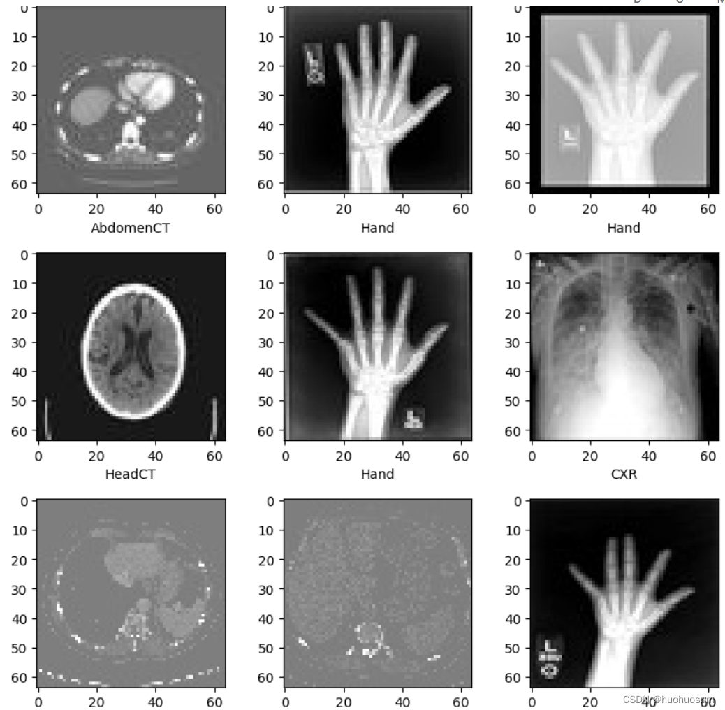 基于Kaggle学习MONAI（一）_medical image classification tutorial with the med ...
