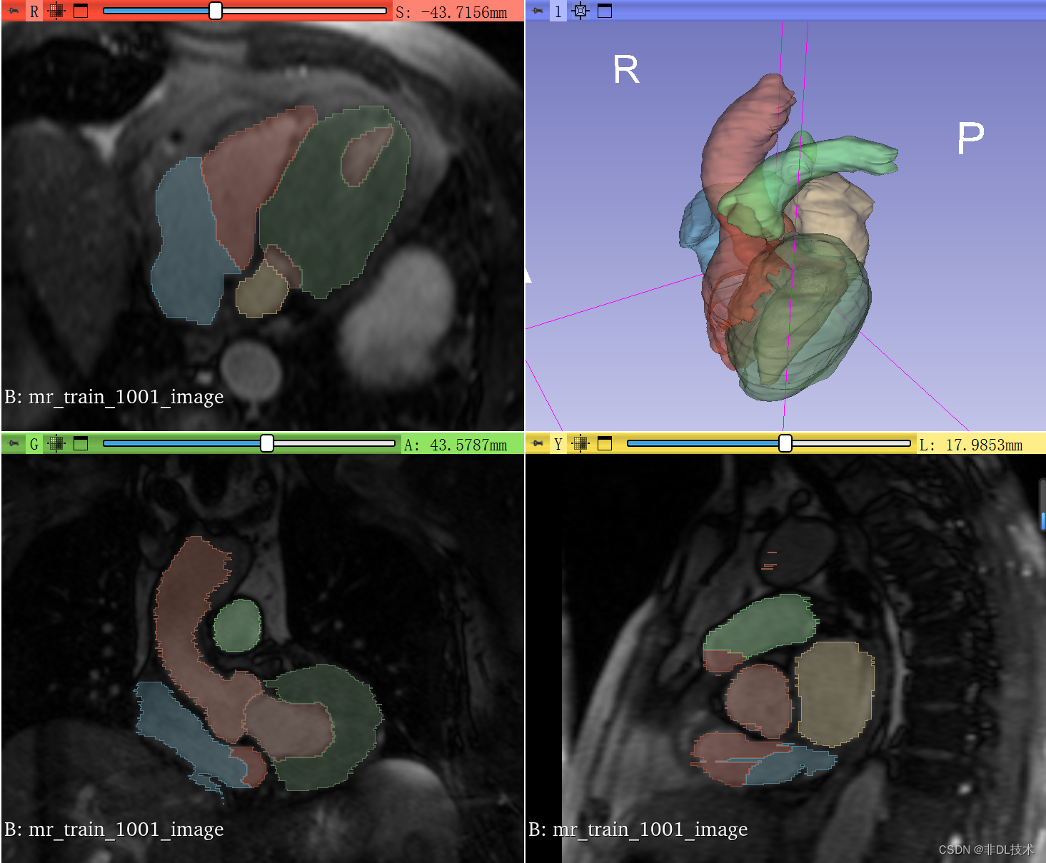 多模态全心分割数据集MM-WHS 2017_mmwhs数据集-CSDN博客