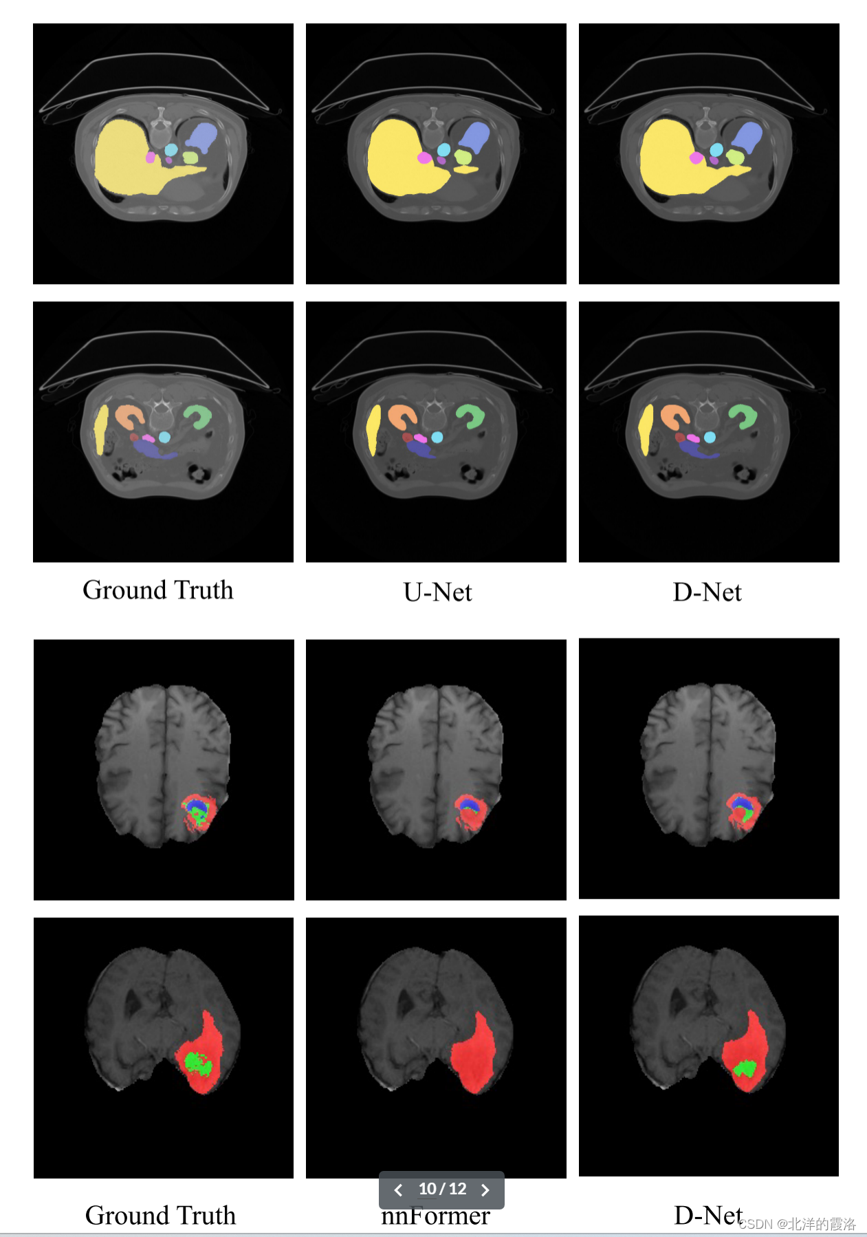《D-Net: Dynamic Large Kernel with DynamicFeature Fusion for Volumetric ...
