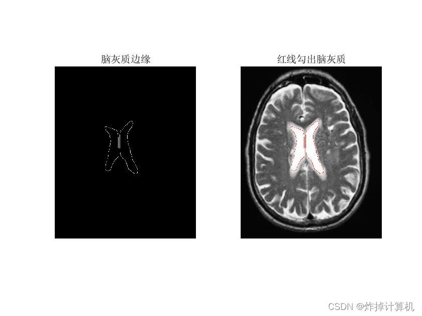 Matlab 区域生长法 基于区域生长法的脑白（灰）质的分割matlab区域生长法 Csdn博客