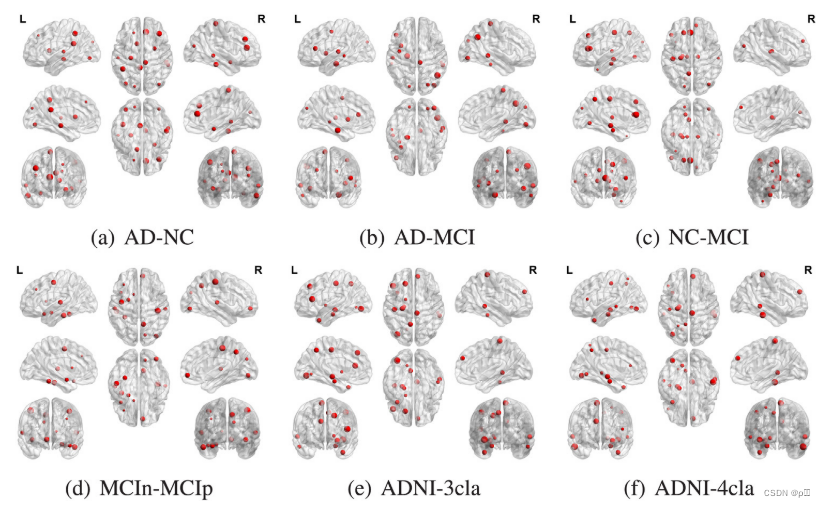 文献解读04-Interpretable learning based Dynamic Graph Convolutional Networks for Alzheimer’s Disease ...