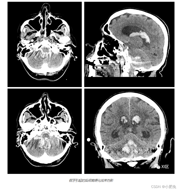 CT伪影：根本原因与规避方法_小鼠ct运动伪影-CSDN博客