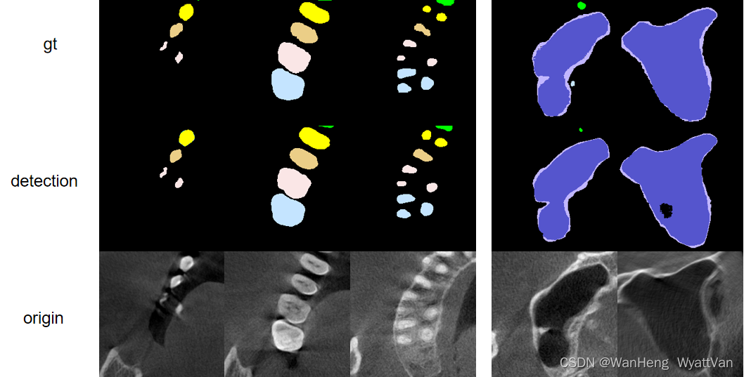 【代码实践】focal loss损失函数及其变形原理详细讲解和图像分割实践（含源码）-CSDN博客