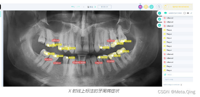 6 种创新的人工智能在牙科领域的应用牙齿正畸加深度学习 Csdn博客 