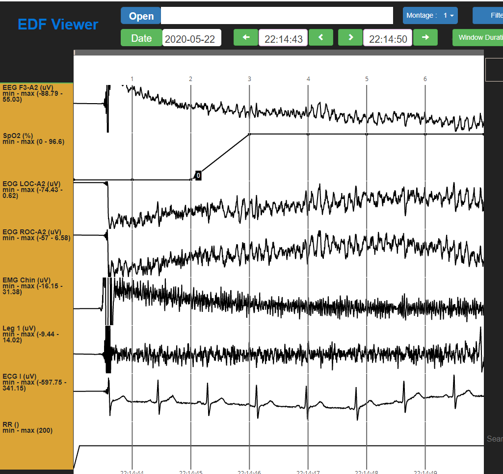 PSG开发.edf文件格式解析_怎样将psg数据存储成edf格式-CSDN博客