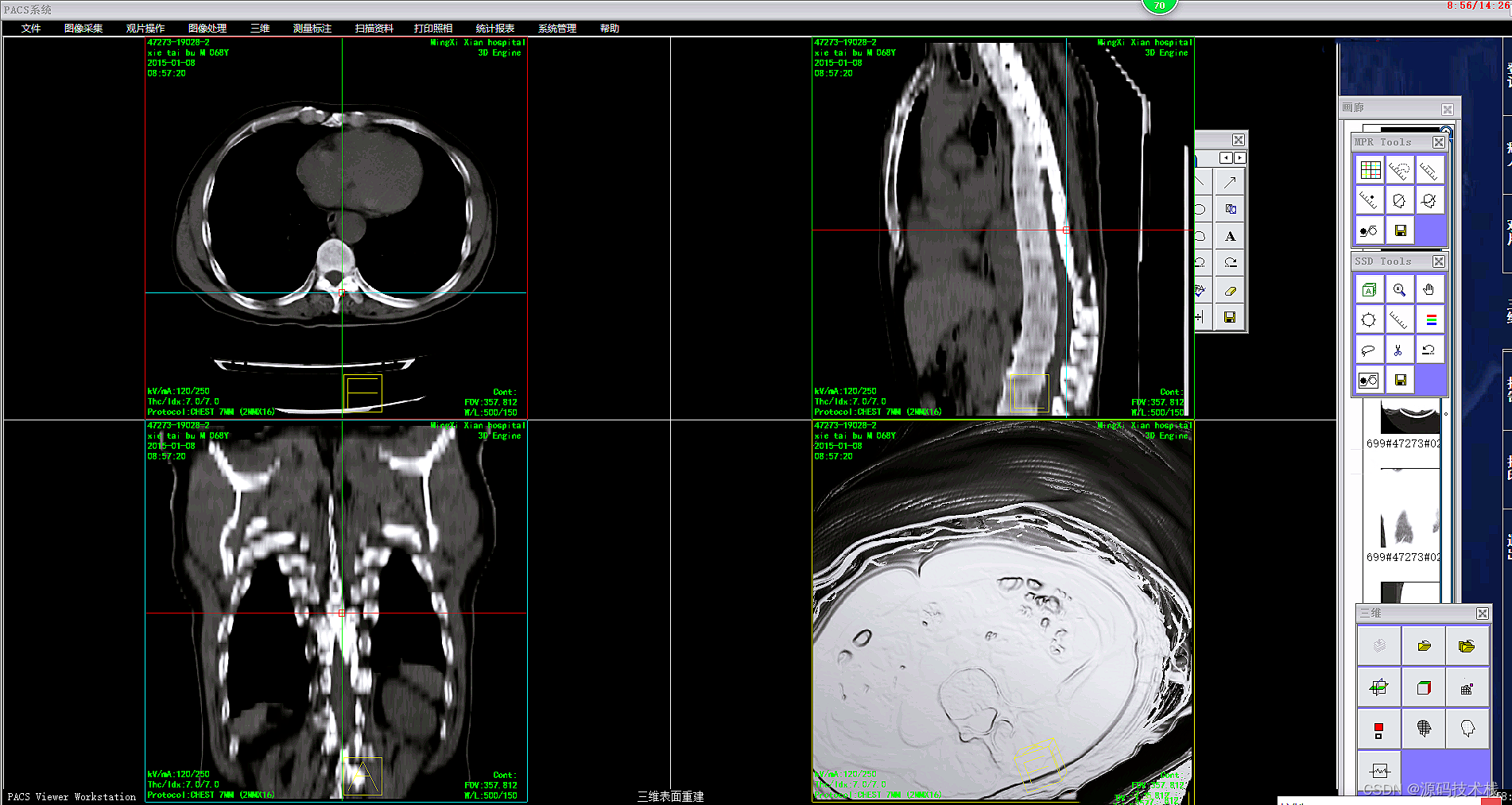 PACS系统源码：CT后处理技术之仿真内镜CTVE_ge仿真内窥镜后处理怎么做-CSDN博客