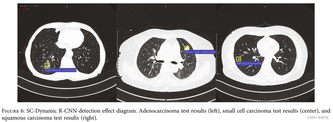 论文翻译：SC-Dynamic R-CNN: A Self-Calibrated Dynamic R-CNN Model for Lung Cancer Lesion Detection ...