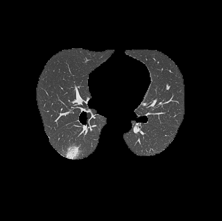 肺实质分割python实现_python分割肺部算法-CSDN博客