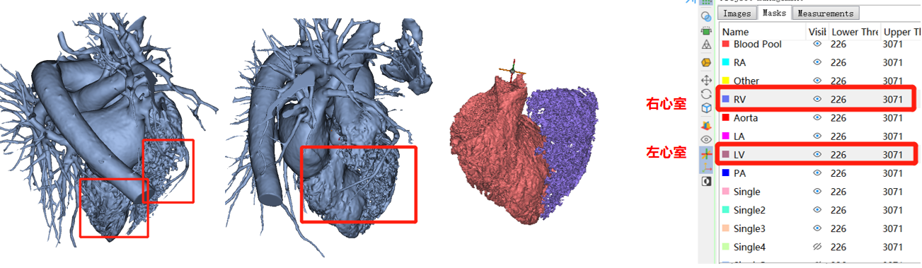 【Mimics】基于心脏ct影像重建3d模型 孔洞修复平滑处理 及 合并导出_ct数据 3d建模-CSDN博客