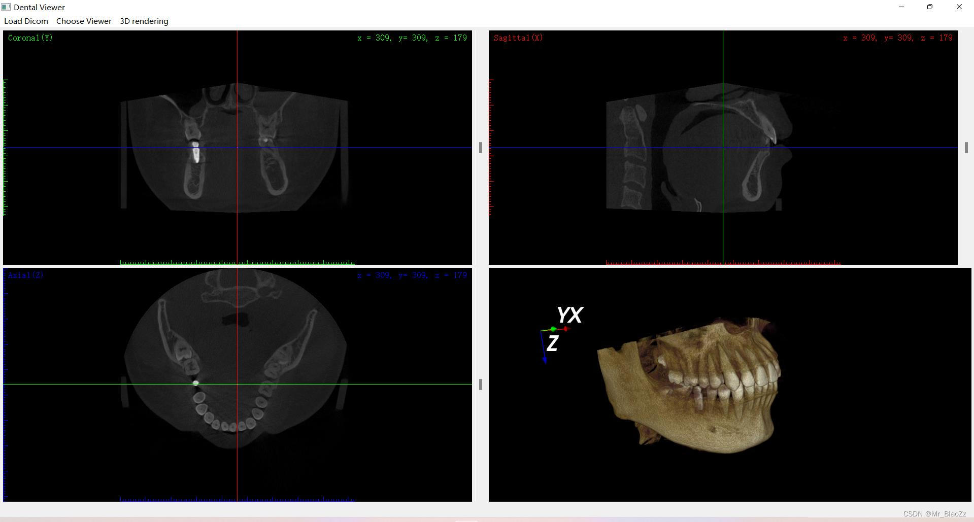 牙科医学四视图+vtk三维重建+口腔全景图像重建（pyqt5+python）- V2.0_全景片重建模块计算采样点的重建像素值,将采样点的重建像素值作为口腔全景片图像-CSDN博客