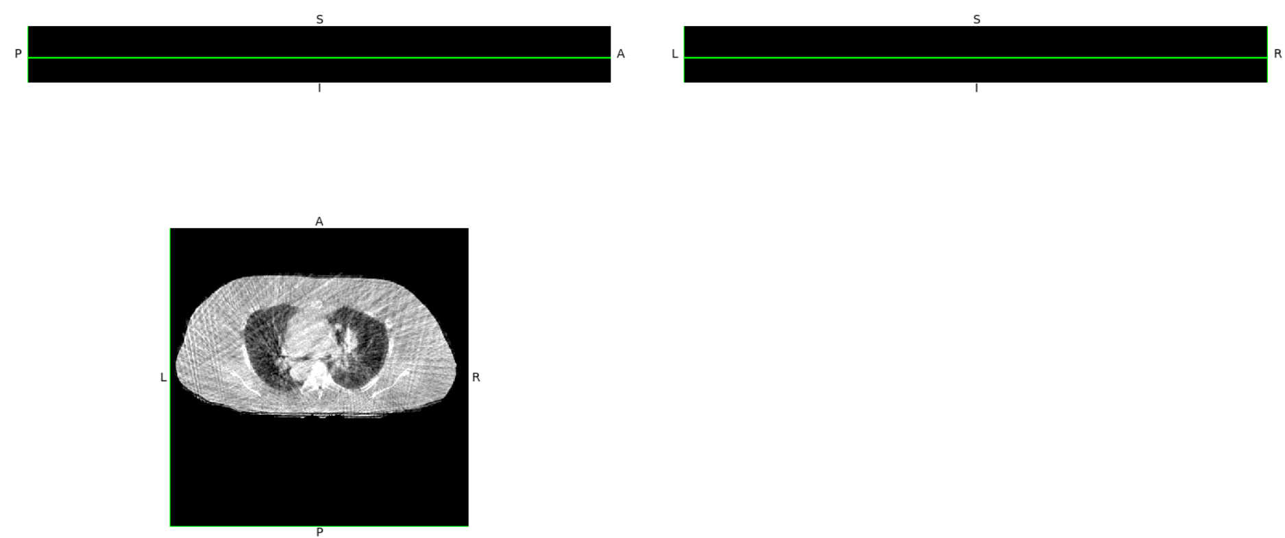 DICOM的理解与学习2_ct图像如何去除床印记-CSDN博客