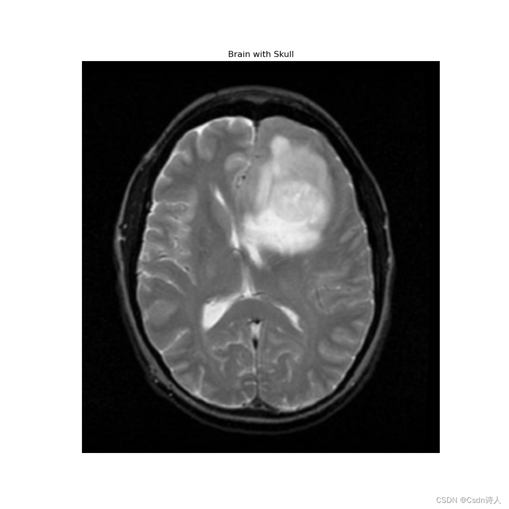 头骨剥离MRI_用python语言实现去除脑部mri图像中的头骨-CSDN博客