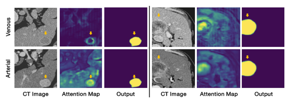 [深度学习论文笔记]Modality-aware Mutual Learning for Multi-modal Medical Image Segmentation_双时相图像是什么-CSDN博客