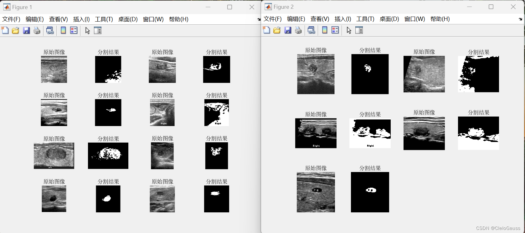 图像分割及其实现过程（matlab篇代码）gac模型代码 Csdn博客