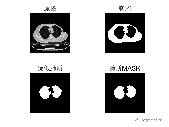 【图像分割】基于计算机视觉实现胸部CT肺质提取附matlab代码_腹部ct仿体 matlab-CSDN博客