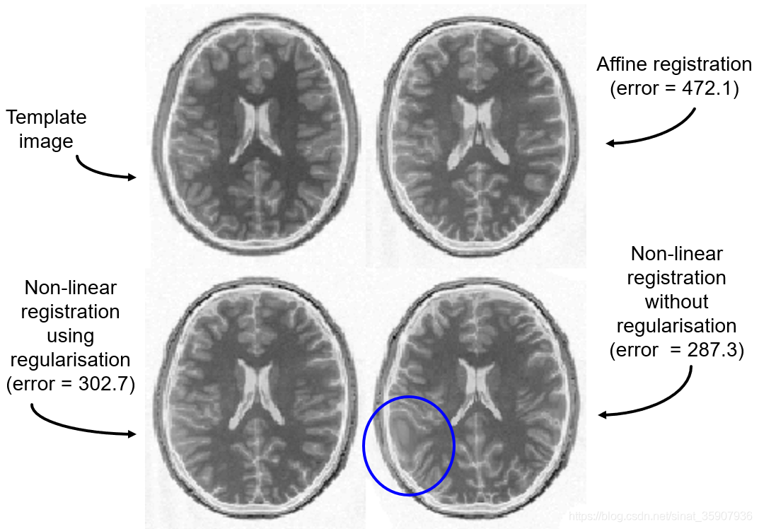 vbm 分析_MRI脑影像分析从哲学到技术：一文搞懂VBM预处理基本原理（全网最详细解析）..._weixin_39742392的博客-CSDN博客