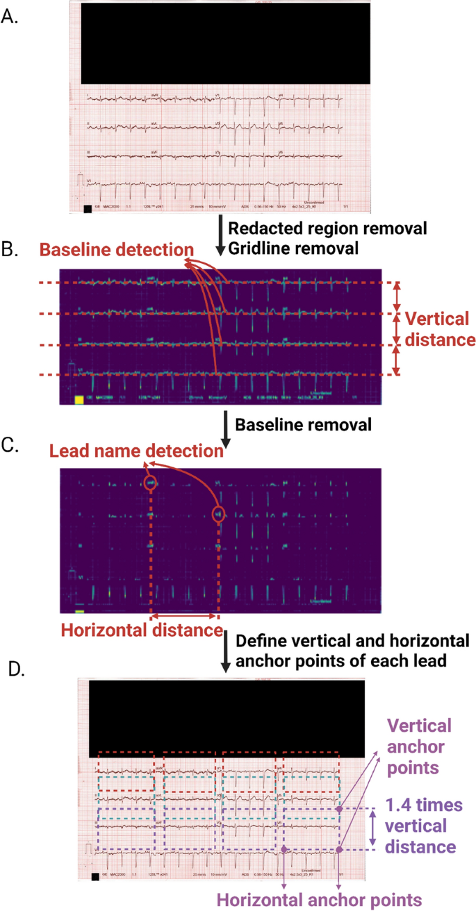 一种基于深度学习的全自动纸心电图数字化算法-CSDN博客