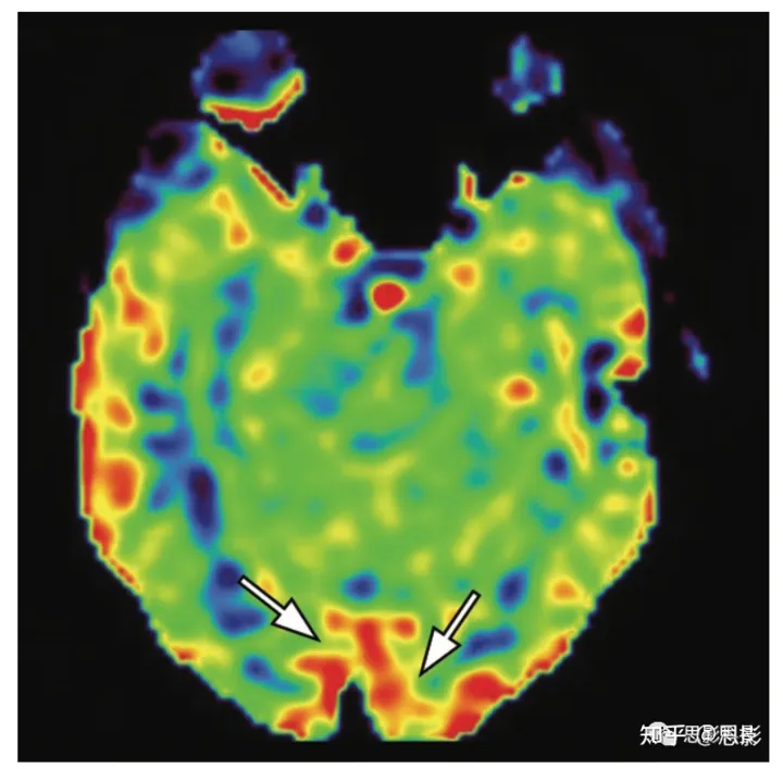 动脉自旋标记：技术、临床应用和解释_asl的rcbf(相对灌注量)和绝对cbf(绝对灌注量)预处理-CSDN博客