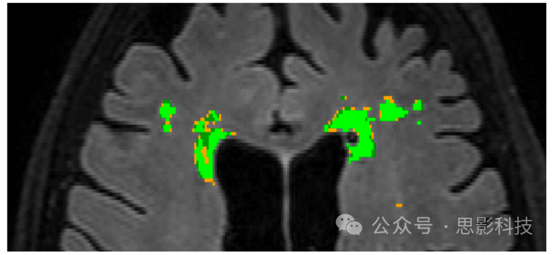 FreeSurfer、UBO Detector和BIANCA提取白质高信号性能比较-CSDN博客